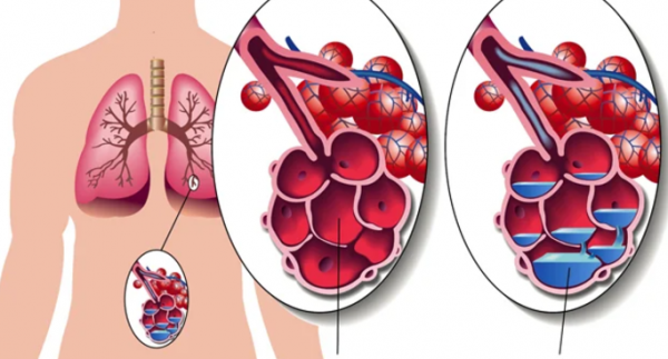 Surviving Sepsis Campaign: International Guidelines for Management of ...