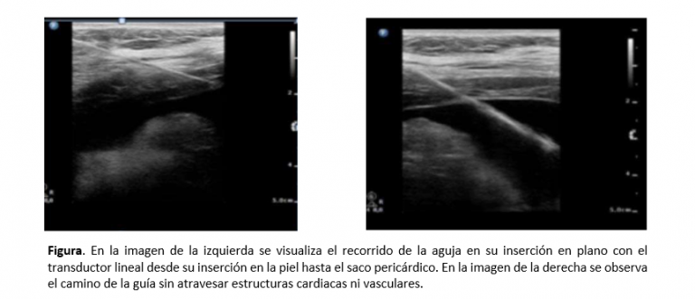 Taponamiento cardíaco – Cuidados Intensivos