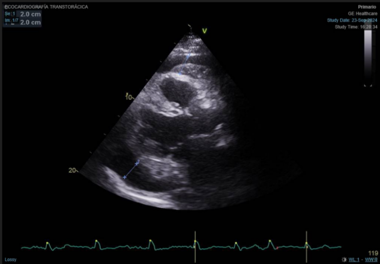 DERRAME PERICARDICO – Cuidados Intensivos