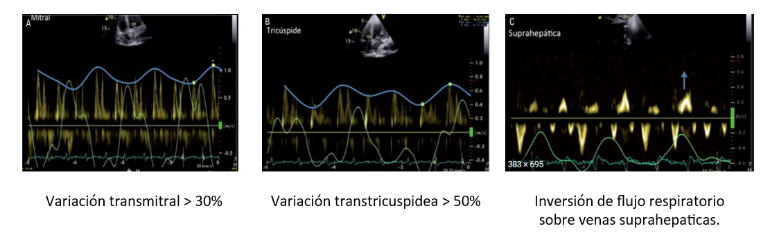 Taponamiento Cardíaco Cuidados Intensivos